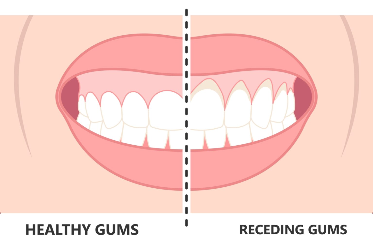 Best 6 Tips for Preventing Receding Gums!